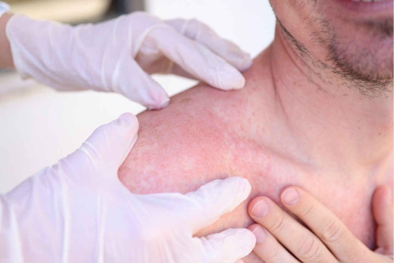 Why does skin get red rashes and itching in winter? Know the reasons ...